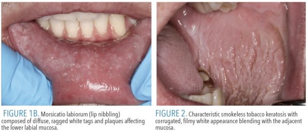 Diagnostic Tips for Benign White Oral Mucosal Lesions - Dimensions of ...
