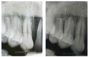 Avoiding Errors in Digital Radiography - Dimensions of Dental Hygiene