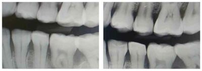 Avoiding Errors in Digital Radiography - Dimensions of Dental Hygiene