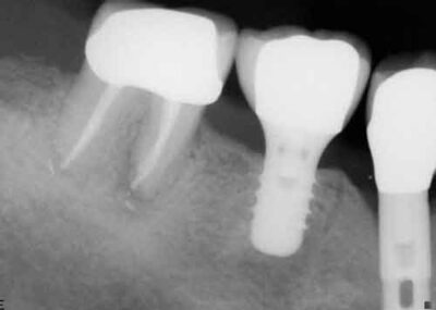 Strategies to Address Periodontally Involved Furcations - Dimensions of ...