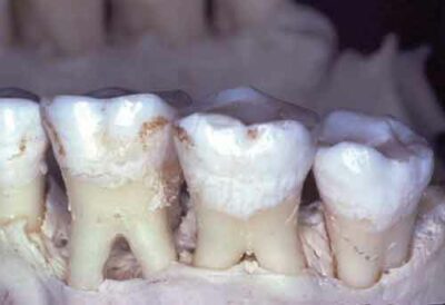 Strategies to Address Periodontally Involved Furcations - Dimensions of ...