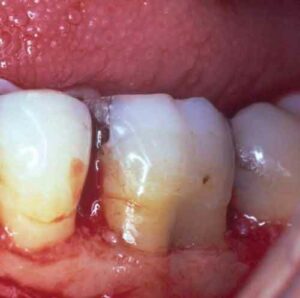 Strategies to Address Periodontally Involved Furcations - Dimensions of ...