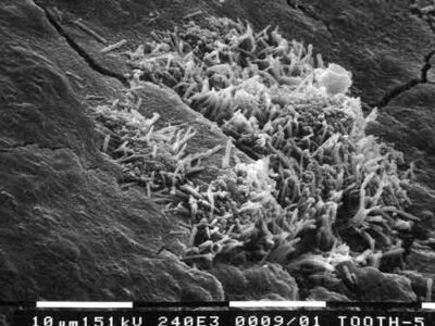 The Importance of Effective Scaling and Root Planing - Dimensions of ...