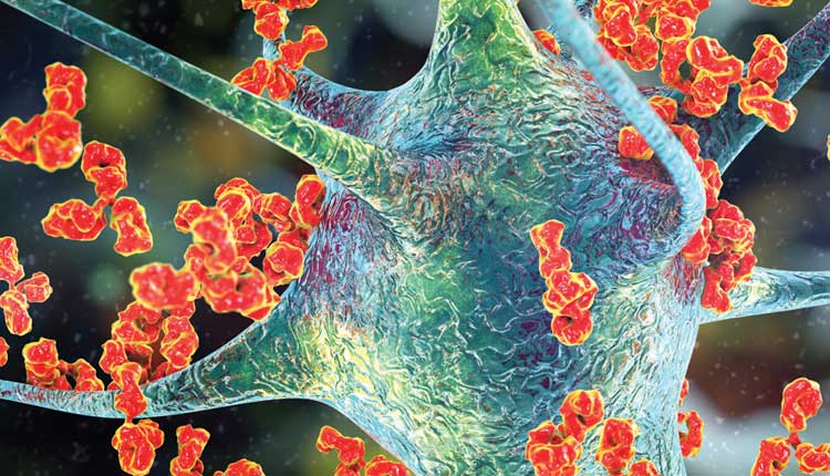 Recognize the Manifestations of Autoimmune Diseases - Dimensions of ...