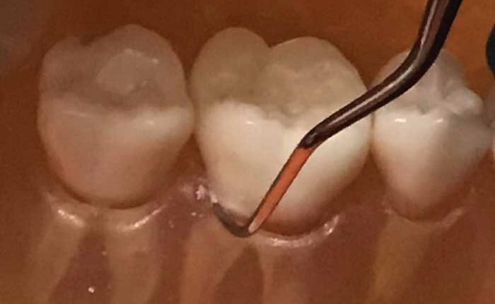 extend-reach-4 - Dimensions of Dental Hygiene | Magazine