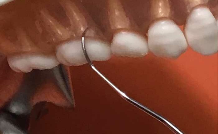 extend-reach-6 - Dimensions of Dental Hygiene | Magazine