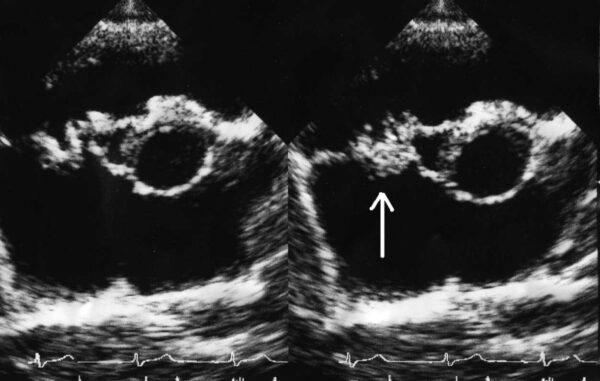 A Closer Look at the AHA's Antibiotic Prophylaxis Guidelines ...