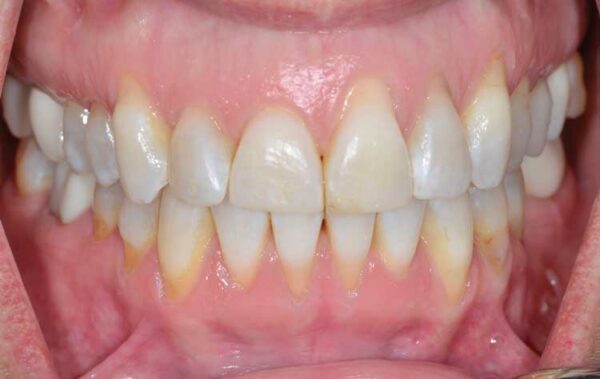 A Tunneling Treatment Approach to Gingival Recession - Dimensions of ...