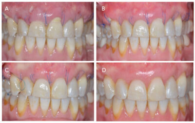 A Tunneling Treatment Approach to Gingival Recession - Dimensions of ...