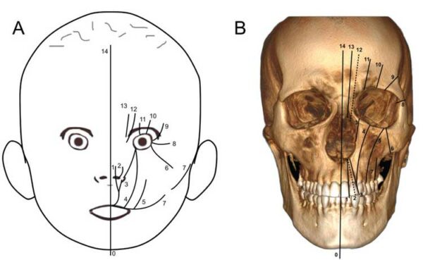 Imaging Techniques for Patients with Cleft Lip and/or Palate ...