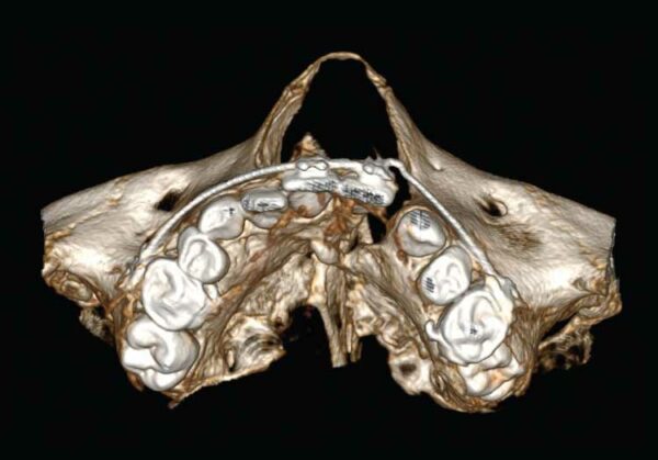 Imaging Techniques for Patients with Cleft Lip and/or Palate ...
