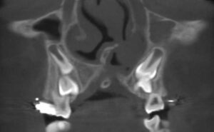 Imaging Techniques for Patients with Cleft Lip and/or Palate ...