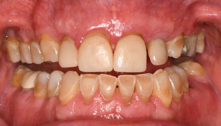 Achieve Success in Esthetic and Functional Crown Lengthening ...