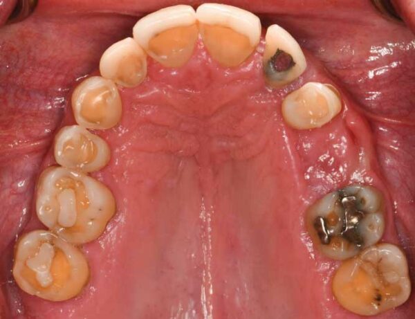 Achieve Success in Esthetic and Functional Crown Lengthening ...