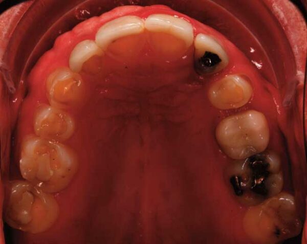 Achieve Success in Esthetic and Functional Crown Lengthening ...