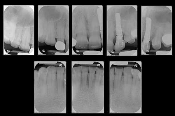 Achieve Success in Esthetic and Functional Crown Lengthening ...