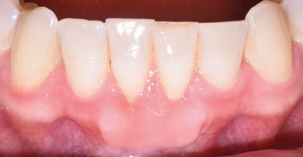 A Free Gingival Graft Saves the Day - Dimensions of Dental Hygiene