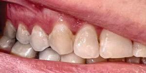 Managing Enamel Demineralization - Dimensions of Dental Hygiene