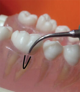 Ultrasonic Instrumentation Is Key to Successful Perio Maintenance ...