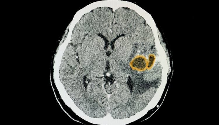 Does Poor Oral Health Raise the Risk for Cerebral Abscesses ...