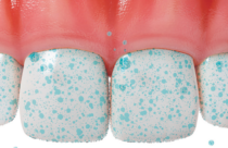 A New Paradigm in Interproximal Plaque Removal