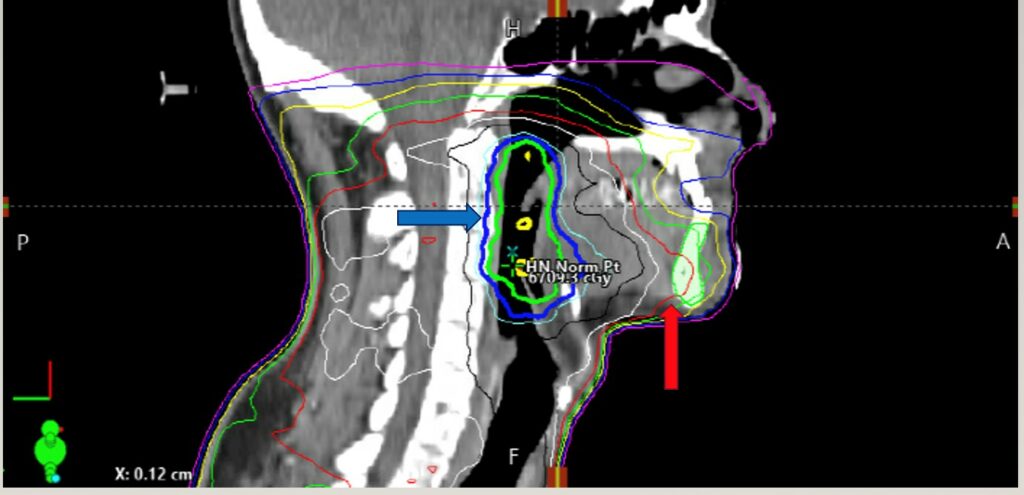 Treatment Considerations for Patients With a History of Head and Neck ...