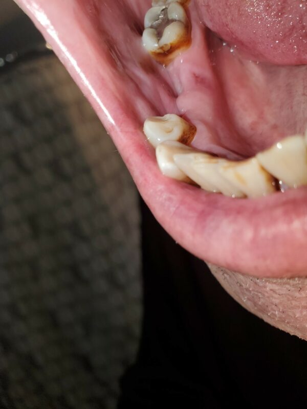 Treatment Considerations for Patients With a History of Head and Neck ...