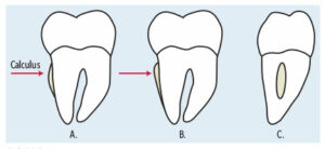 Removing Burnished Calculus - Dimensions of Dental Hygiene