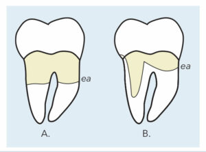 Removing Burnished Calculus - Dimensions of Dental Hygiene