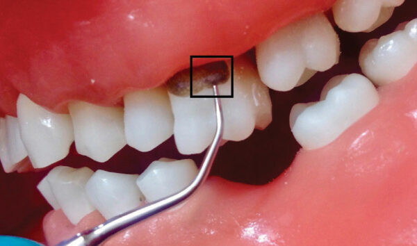 Removing Burnished Calculus - Dimensions of Dental Hygiene