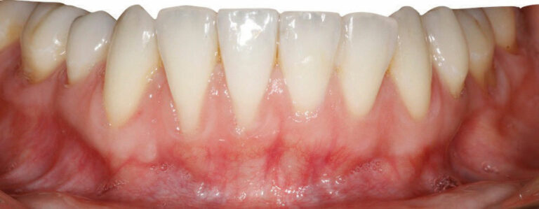 The Role of Non-Autogenous Grafts in Treating Mucogingival Defects ...