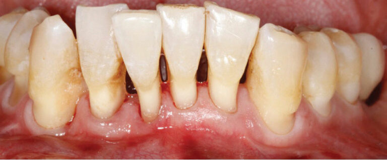 The Role of Non-Autogenous Grafts in Treating Mucogingival Defects ...