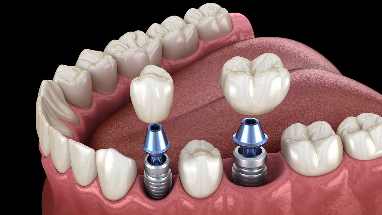 UCLA Team Invents UV Treatment to Improve Implant Outcomes - Dimensions ...