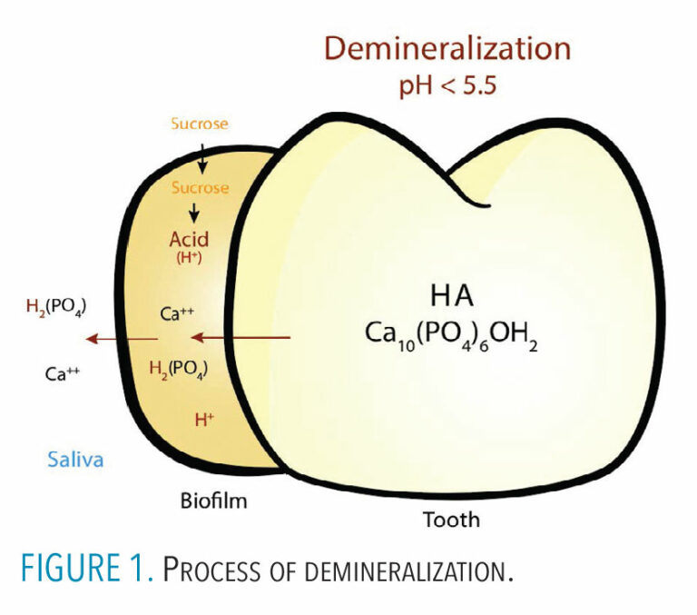 Maintaining the Balance Between Remineralization and Demineralization ...