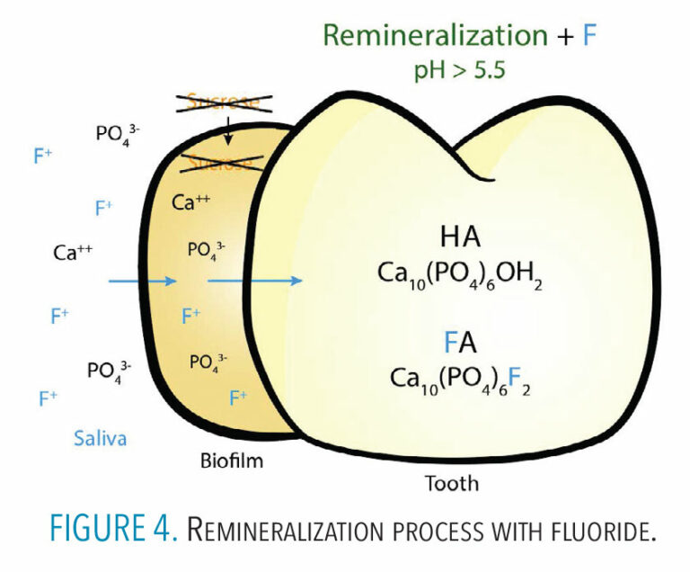 Maintaining the Balance Between Remineralization and Demineralization ...