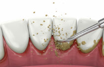 The Concept of Biologic Width in Restorative Dentistry - Dimensions of ...