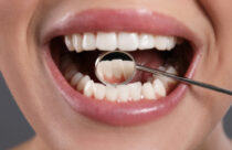 The Concept of Biologic Width in Restorative Dentistry - Dimensions of ...