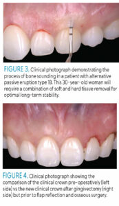 Understanding Altered Passive Eruption - Dimensions of Dental Hygiene