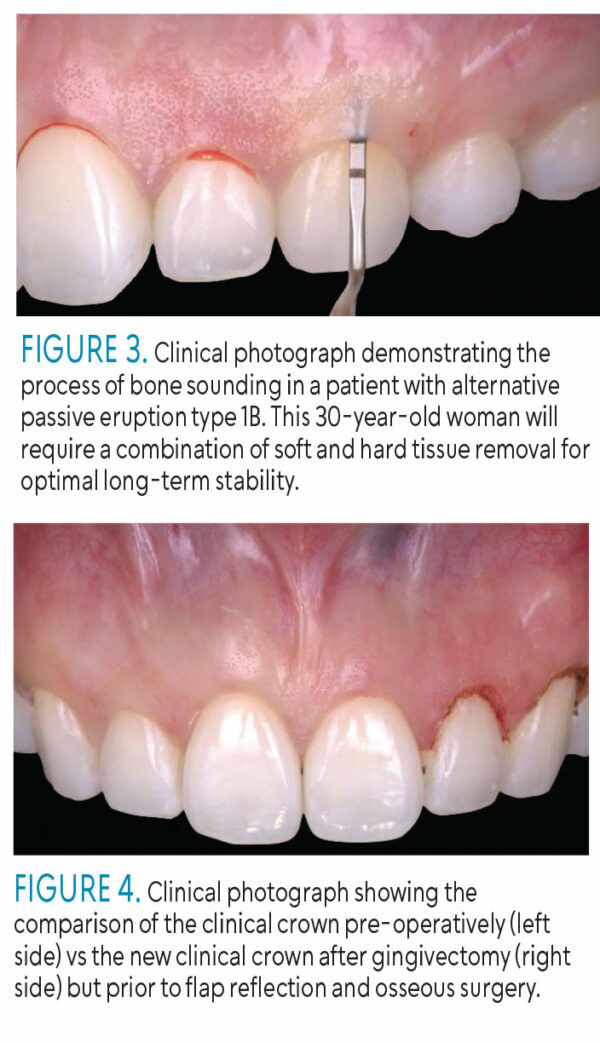 Understanding Altered Passive Eruption - Dimensions of Dental Hygiene