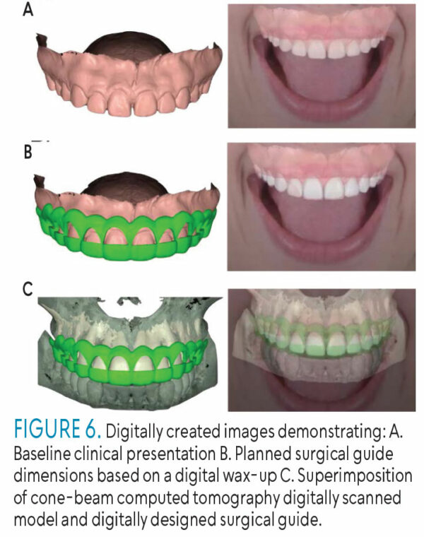 Understanding Altered Passive Eruption - Dimensions of Dental Hygiene