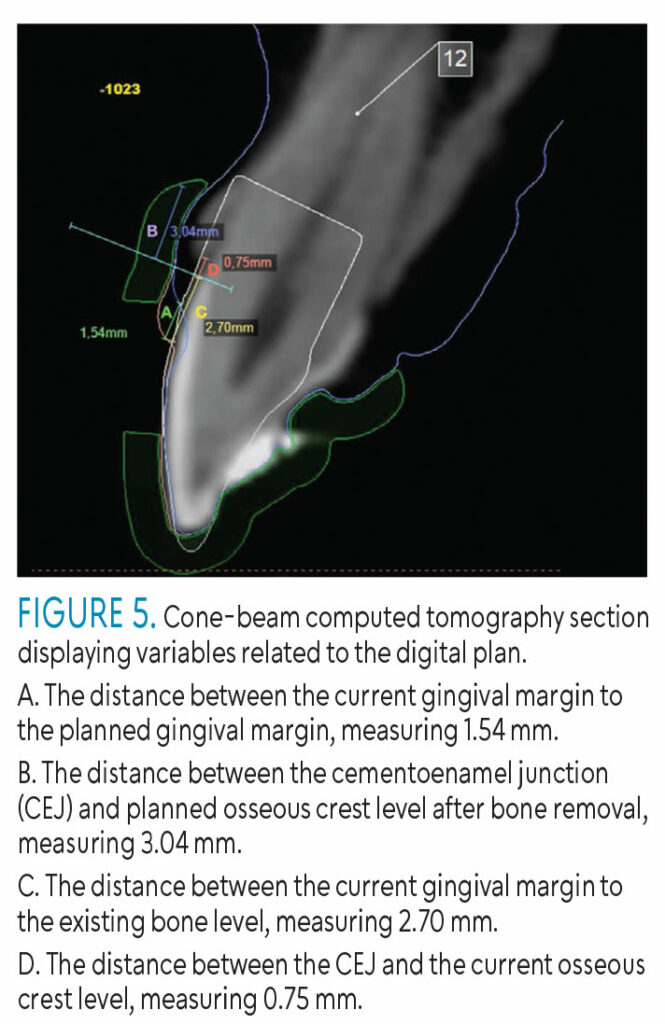 Understanding Altered Passive Eruption - Dimensions of Dental Hygiene