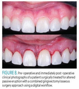 Understanding Altered Passive Eruption - Dimensions of Dental Hygiene