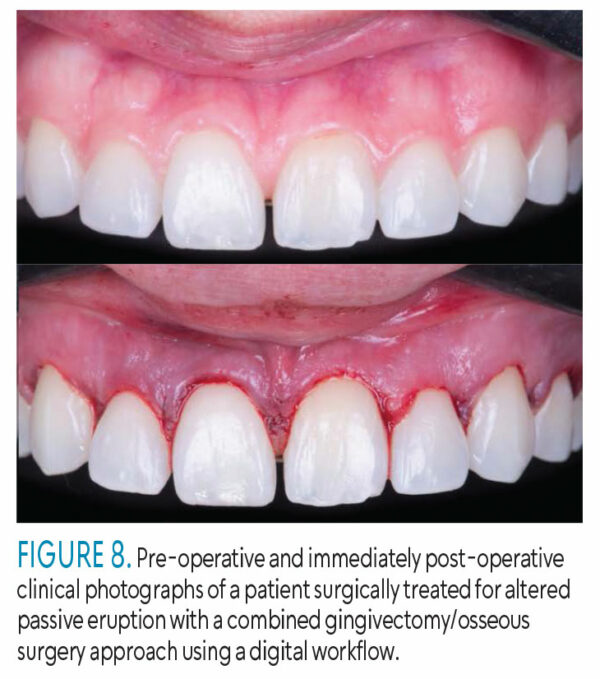 Understanding Altered Passive Eruption - Dimensions of Dental Hygiene