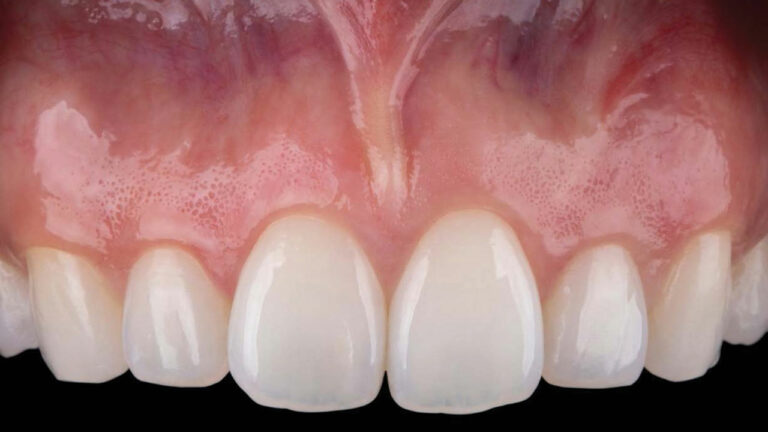 Understanding Altered Passive Eruption - Dimensions of Dental Hygiene