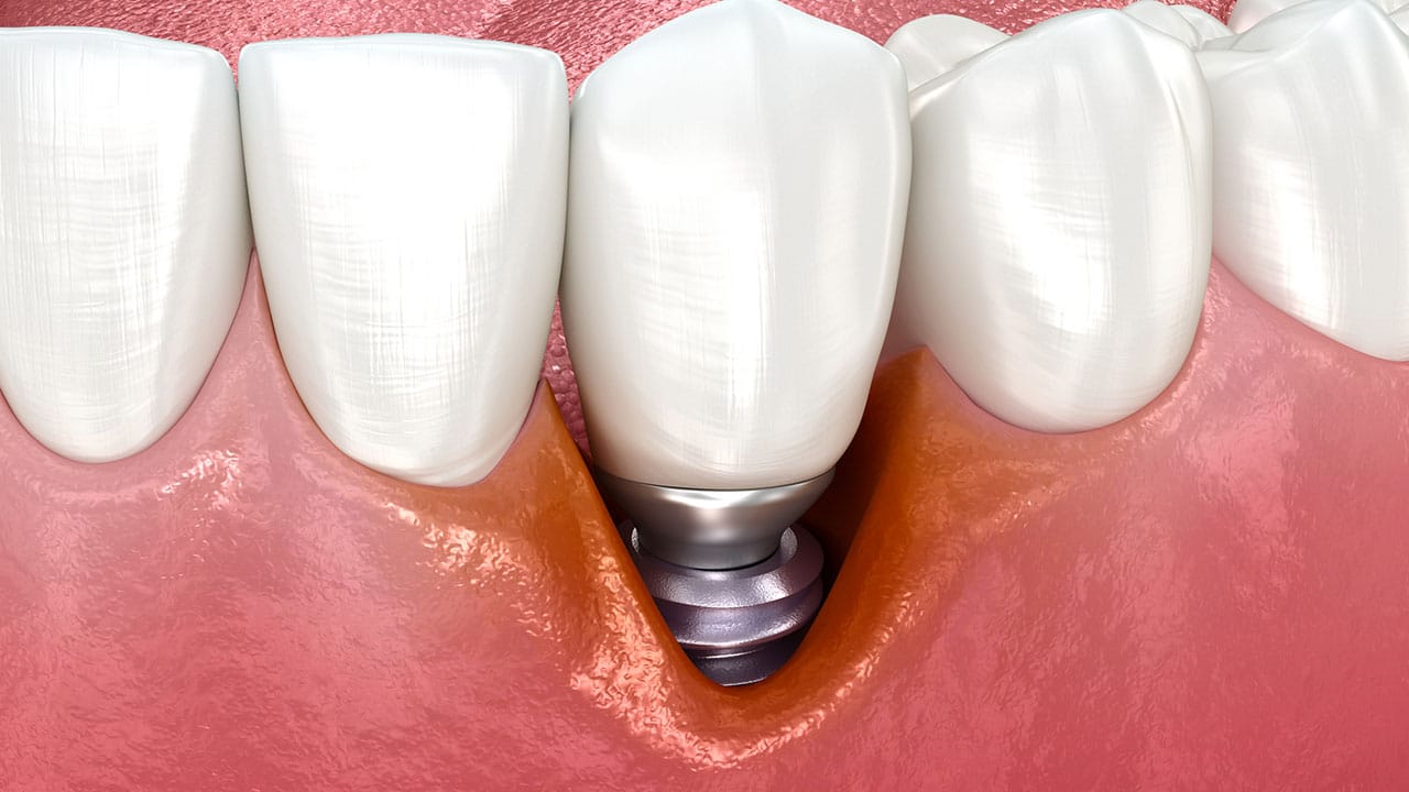 A Case Study in Managing Peri-Implantitis: A 5-Year Follow-Up ...