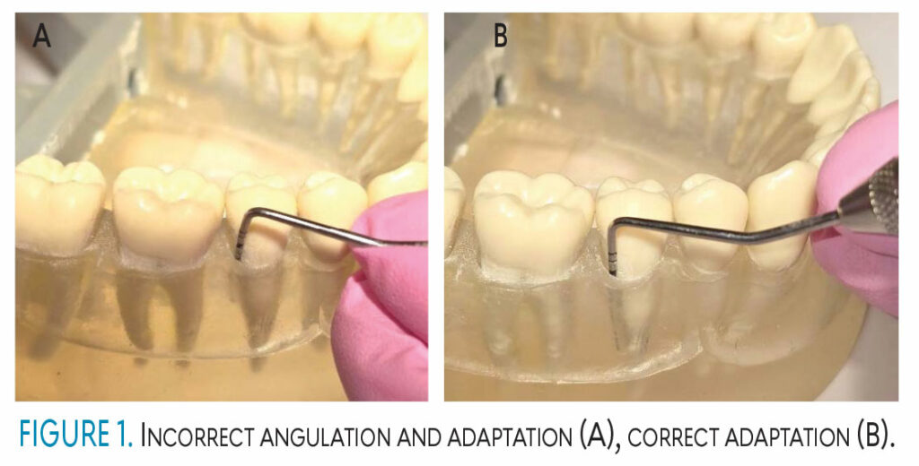 The Importance of Probes in Assessing Periodontal Health - Dimensions ...