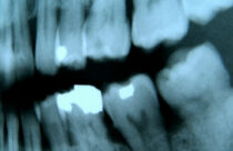 Impact of Periodontal Classification on Treatment Planning - Dimensions ...