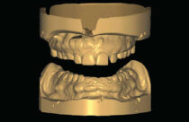 The Concept of Biologic Width in Restorative Dentistry - Dimensions of ...