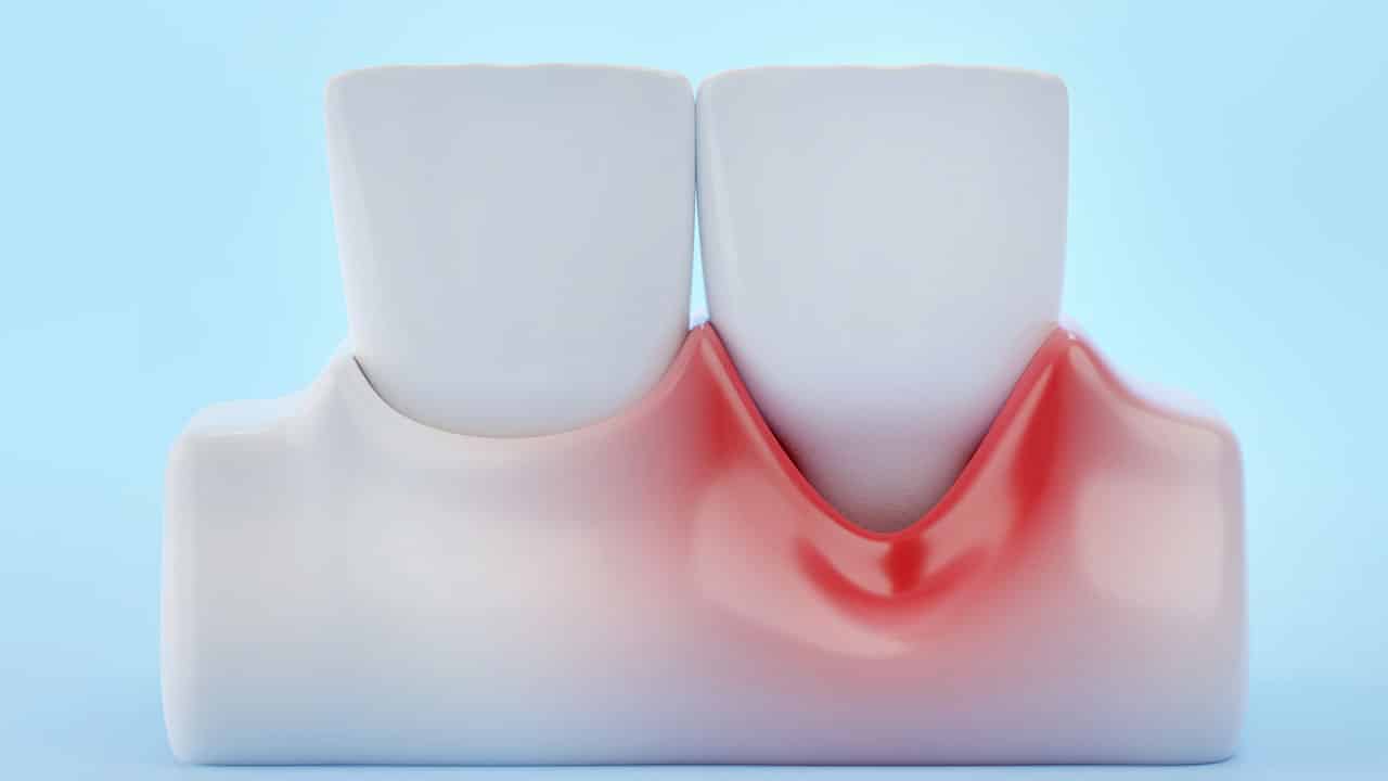 Why Gingival Recession Matters - Dimensions of Dental Hygiene