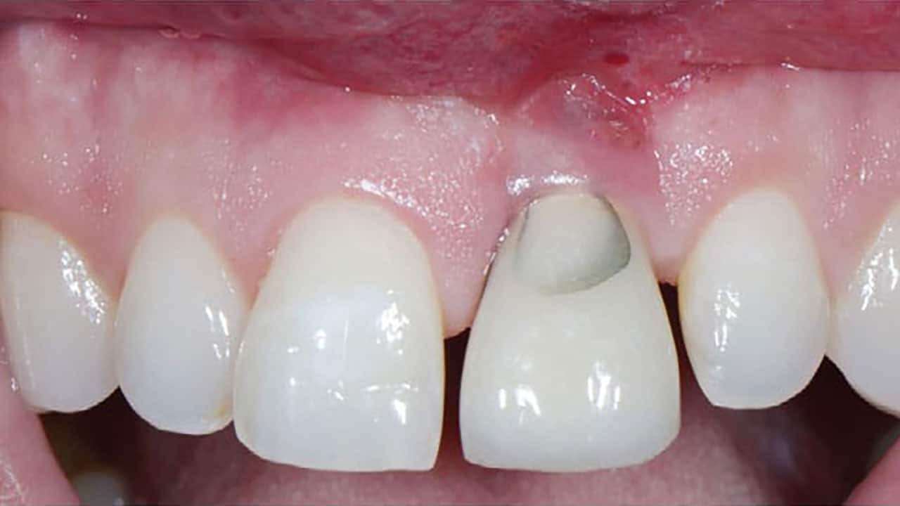 Addressing the Esthetic Challenges of Implant Restorations - Dimensions ...